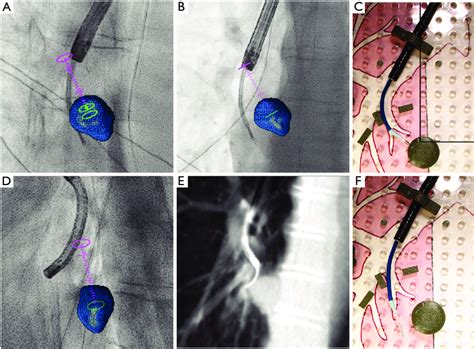 Attempted Biopsy Of The Central Lung Nodule Using A Bronchoscope And