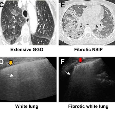 Correlation Of Hrct And Lus Of An Inconsistent Uip Pattern In A Patient