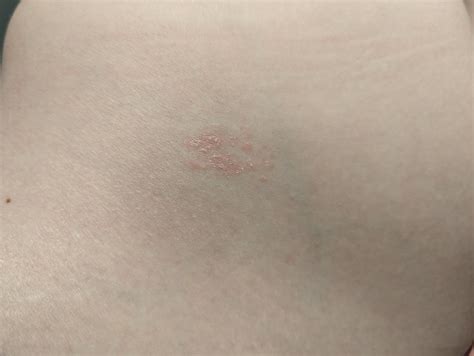 Pinky Toe Swelling And Unhelpful Doctors Rpsoriaticarthritis
