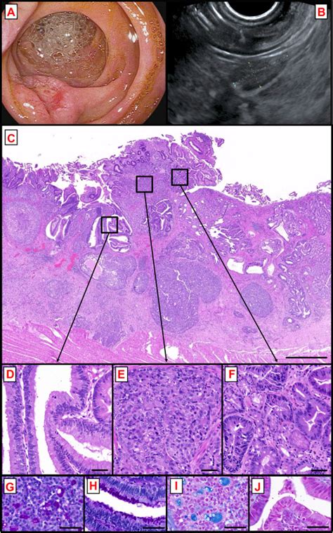 Mixed Acinar Cell Carcinomanon Ampullary Adenocarcinoma Of The