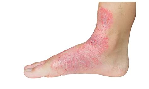 Managing Foot Eczema Causes Symptoms And Treatment Options At Acacia