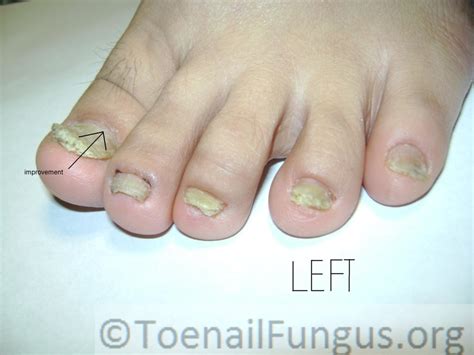 Vinegar Toenail Fungus