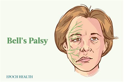 Bells Palsy The Epoch Times