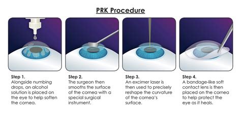Prk Eye Surgery Costs And Procedure Laser Eye Surgery Hub