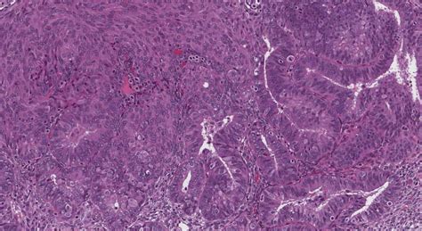 Endometrial Hyperplasia With Atypia Archives Ottawa Atlas Of Pathology