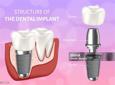 치과 임플란트의 구조를 묘사한 벡터 그림 치과 임플란트 프로세스의 설계 개념 치아 임플란트에 대한 스톡 벡터 아트 및 기타