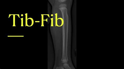 Tib Fib X Ray Positioning Youtube