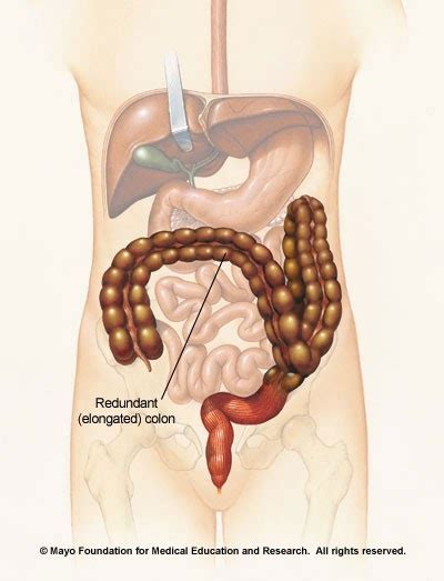 Colonoscopy Prep Diet Mayo Thepiratebaycancer