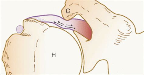 Uw Shoulder And Elbow Academy Coracoid Impingement Is This
