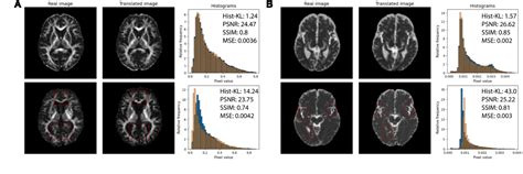 Figure 6 From Synthesis Of Diffusion Weighted Mri Scalar Maps From Flair Volumes Using