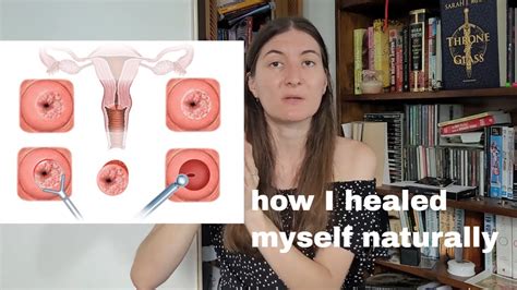 How I Healed Myself From HPV And Cervical Dysplasia CIN 2 High Grade YouTube