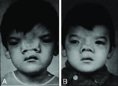 The First Intracranial Approach Case Of Orbital Hypertelorism In China Download Scientific
