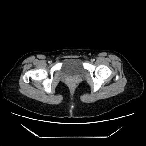 File Crohns Disease Terminal Ileitis Fistulizing Radiopaedia 98245 118784 Axial 161 Jpeg