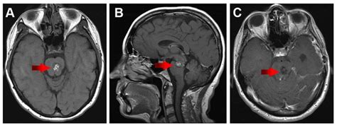 Cavernous Malformation Symptoms Stanford Health Care