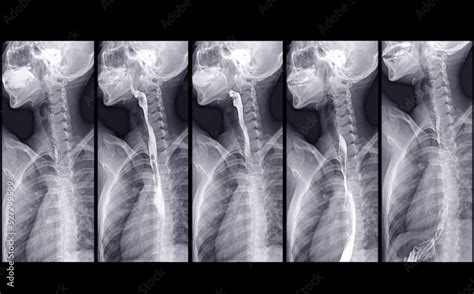 Barium Swallow Study Test Diagnose Barretts Gi Tract Exam Gerd Ulcers