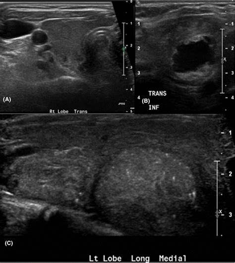 A Right Mid Thyroid Lobe Transverse View B Left Inferior Thyroid