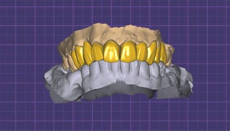 Yahya Salman On Linkedin Exocad Design Dental
