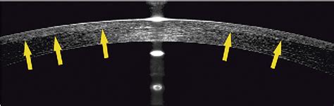 Figure 1 From Combined Laser In Situ Keratomileusis And Prophylactic High‐fluence Corneal