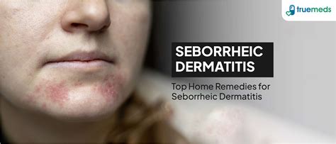 Mild Seborrheic Dermatitis Scalp Seborrheic Dermatitis Of The Scalp