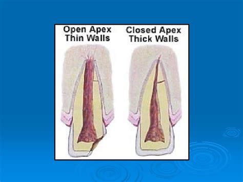 Pulpotomy Apexogenesis And Apexification Pulpotomy Definition Pulpotomy Is