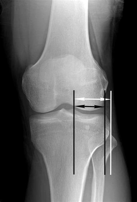The Graph Of Simple Linear Regression Analysis Between The Tibia