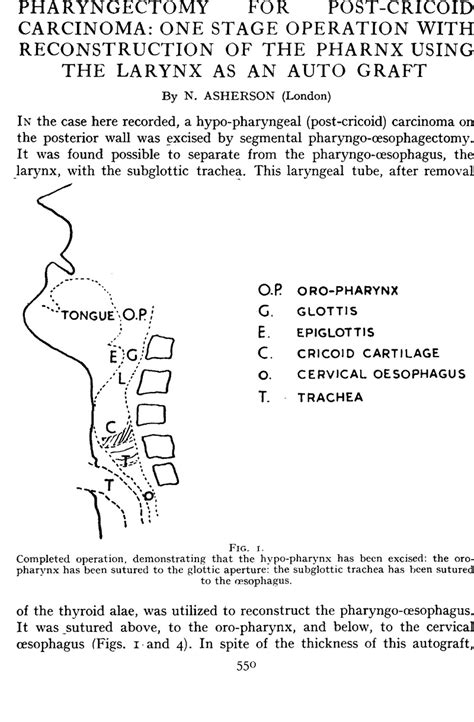 Pharyngectomy For Post Cricoid Carcinoma One Stage Operation With