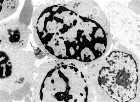 Eritroblastos Con Núcleo Con Cromatina En Esponja