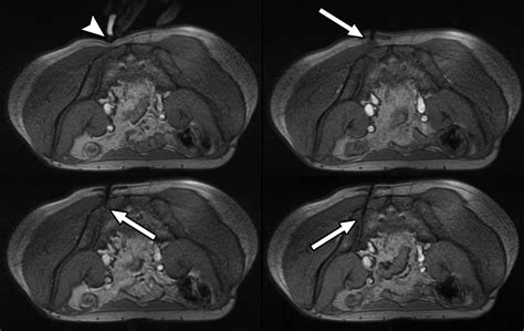 Sacroiliac Joint Dysfunction Mri