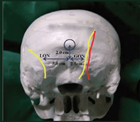Complications Of Occipital Nerve Block And Radiofrequency Lesioning Anesthesia Key