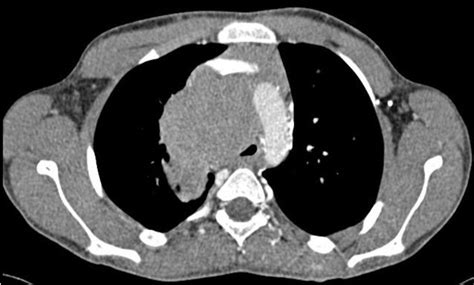 Figure 1 From Thoracic Primitive Neuro Ectodermal Tumor With Superior Vena Cava Syndrome A