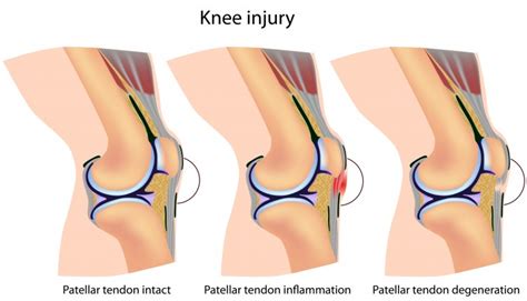 Patella Tendon Injury Symptoms Treatment And Recovery Time
