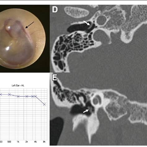 Pdf Hemorrhage Within The Tympanic Membrane Without Perforation