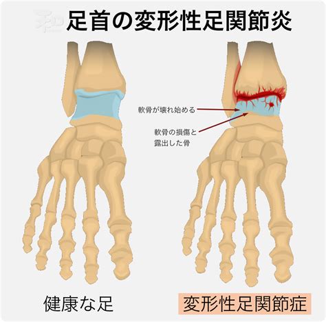 症例11：足を引きずるようになった60歳女性の症状改善までの経過 変形性足関節炎 広島県福山市 和整体・整骨院【なごみ日和】