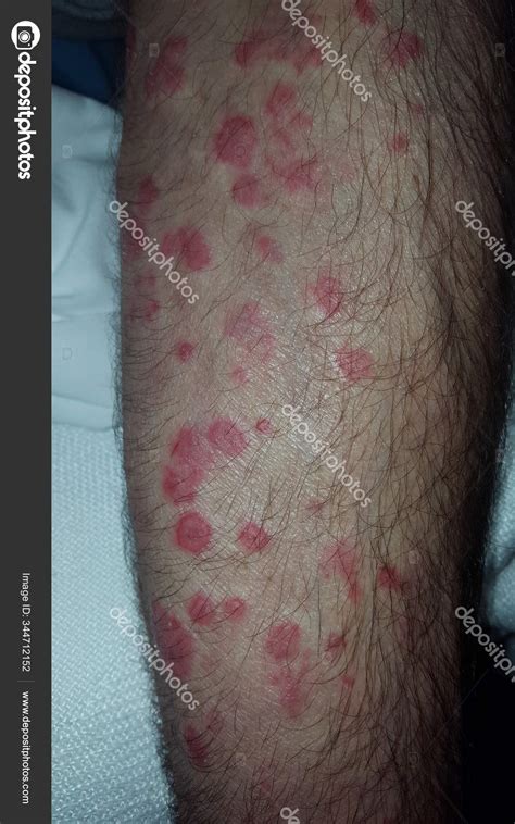 Erythema Multiforme Annular Erythematous Targetoid Skin Lesions Stock