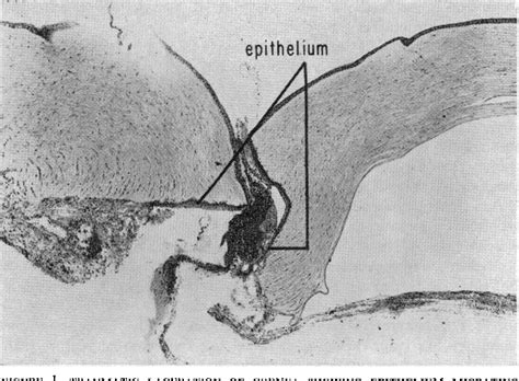 Figure 1 From Epithelization Of The Anterior Chamber Semantic Scholar