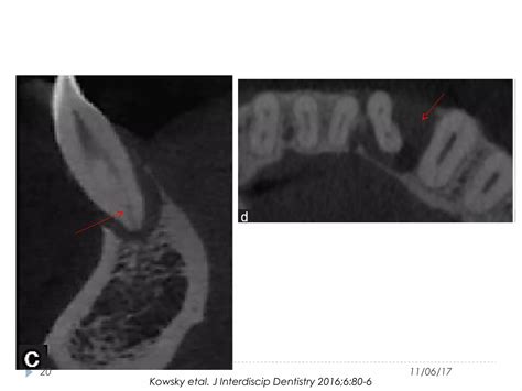 Use Of Cone Beam Computed Tomography In Endodontics Ppt