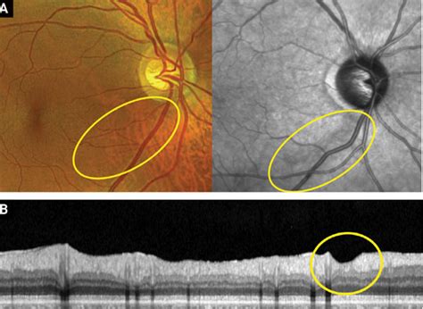 Progression In Glaucoma How To Recognize And React