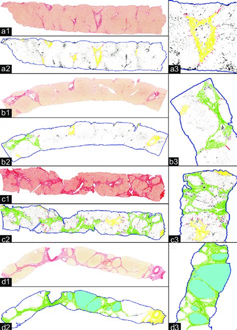 Examples Of Digital Sections Of Metavir Stages F1 A F2 B F3 C Download Scientific