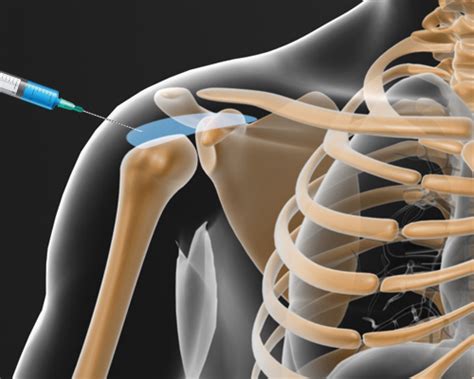 Pes Bursa Injection