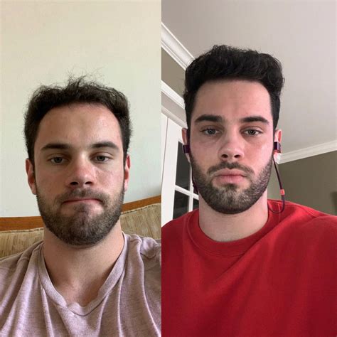 Some Finasteride And Minoxidil Gains R Tressless