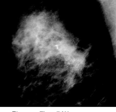 Figure 1 From Detection Of Microcalcification Clusters In Digitized X