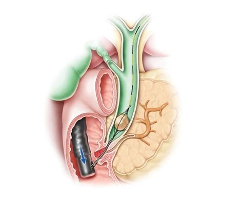 Dr Sameer Gaggar Ercp Endoscopic Retrograde Cholangio Pancreatography