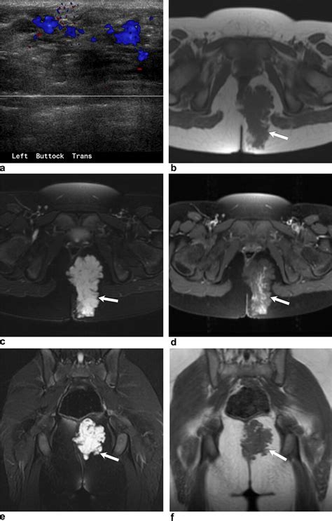 6 Year Old Female Presents With A Discoloration On The Left Buttock A