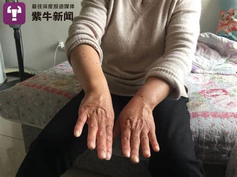 【紫牛头条】50岁单亲妈妈割肾救子为挣钱一天包1000个粽子媒体澎湃新闻 The Paper