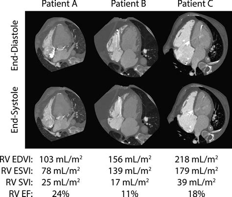 Preoperative Computed Tomography Assessment Of Risk Of Right Asaio