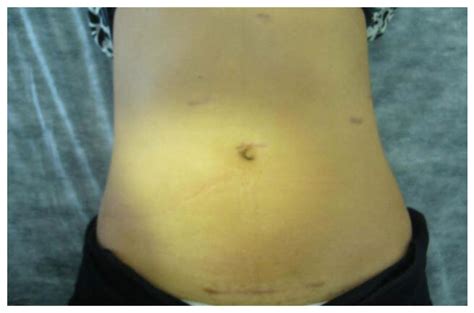 Late Result After Left Lateral Laparoscopic Segmentectomy Download
