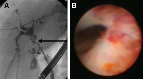 Cholangiogram A And Cholangioscopic Appearance B Of A Benign