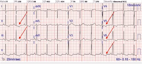 Non ST Elevation Myocardial Infarction Diagnosis And 46 OFF