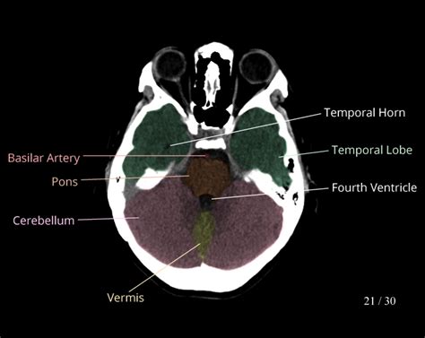 Ct Scan Head Anatomy