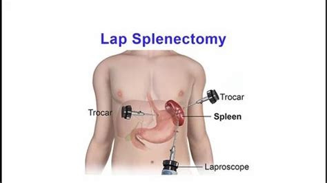 Laparoscopic Splenectomy Surgery Services In Hyderabad Id 18541649973